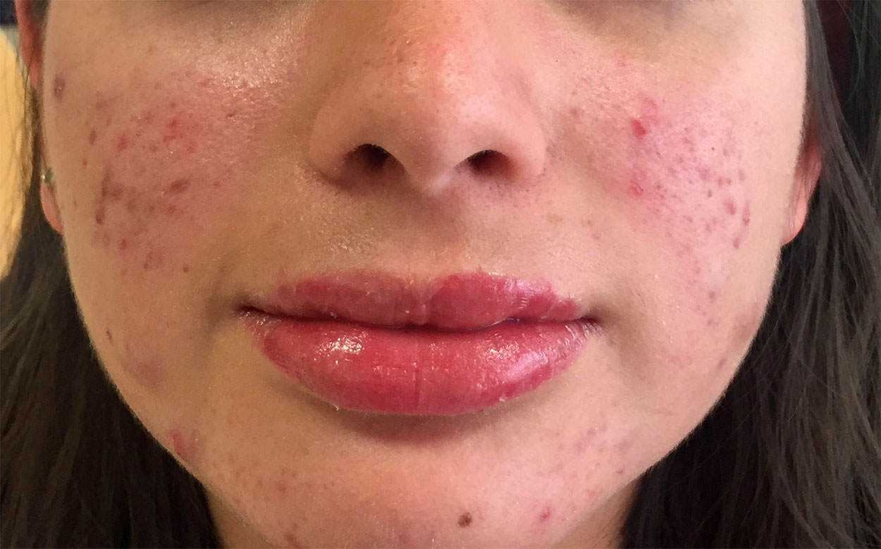 Acne nodulo-cistica - Centro Medico Laser